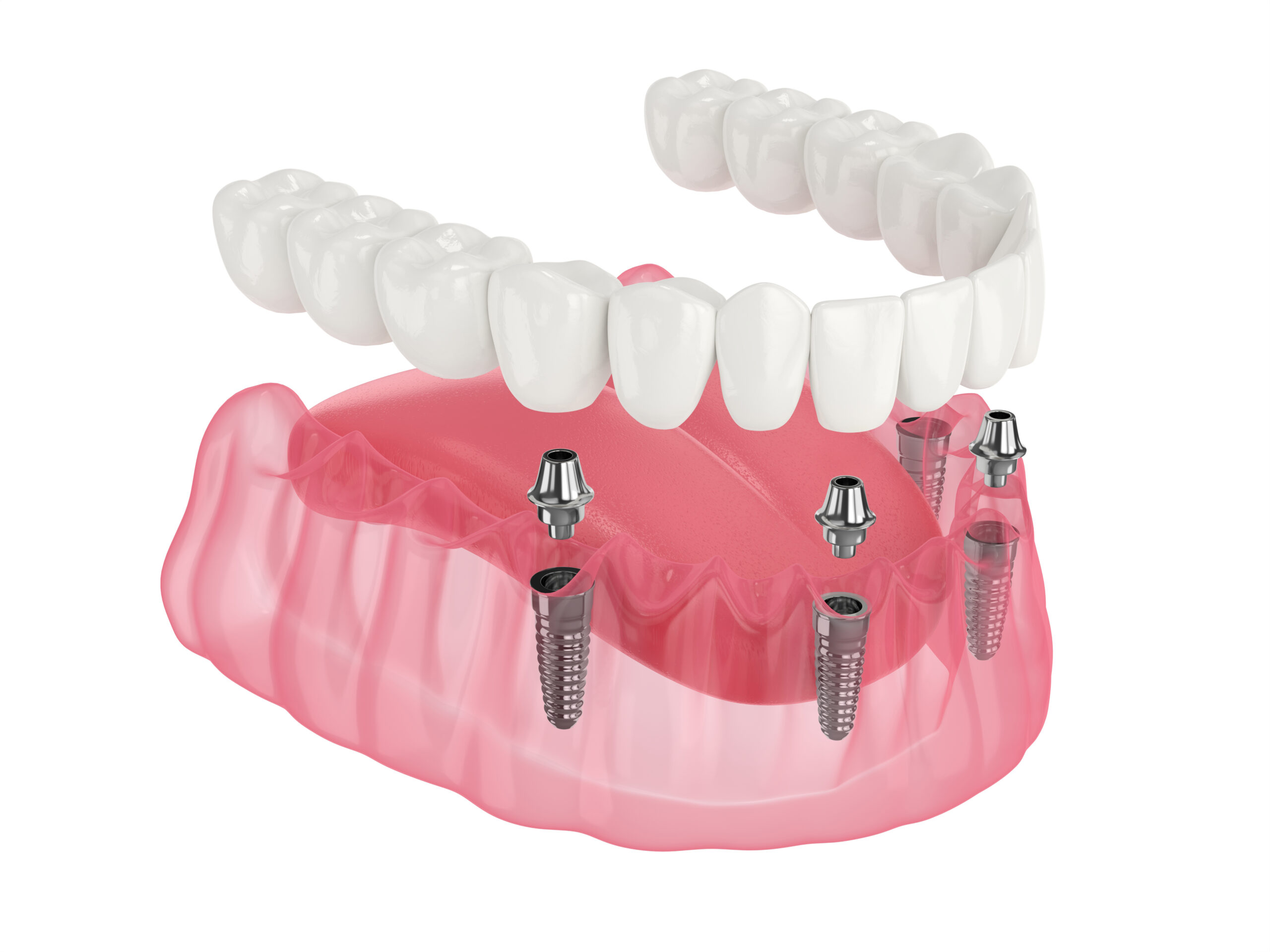 Dental Retained Dentures Cost in Manhattan: Complete Pricing Guide 2025